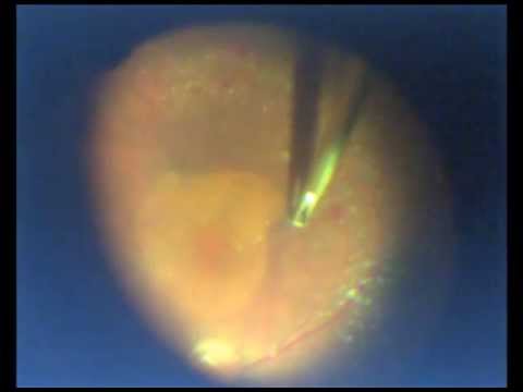 ILM peeling in diabetic eye Dr.Mishev - YouTube