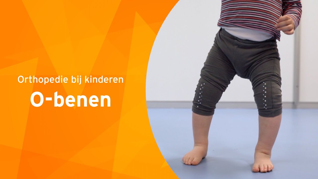 Orthopedie bij kinderen - O-benen - YouTube