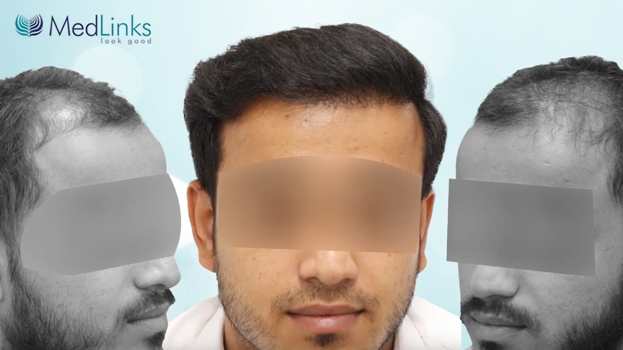 💥best Hair Transplant Results In India Month By Month Result Best