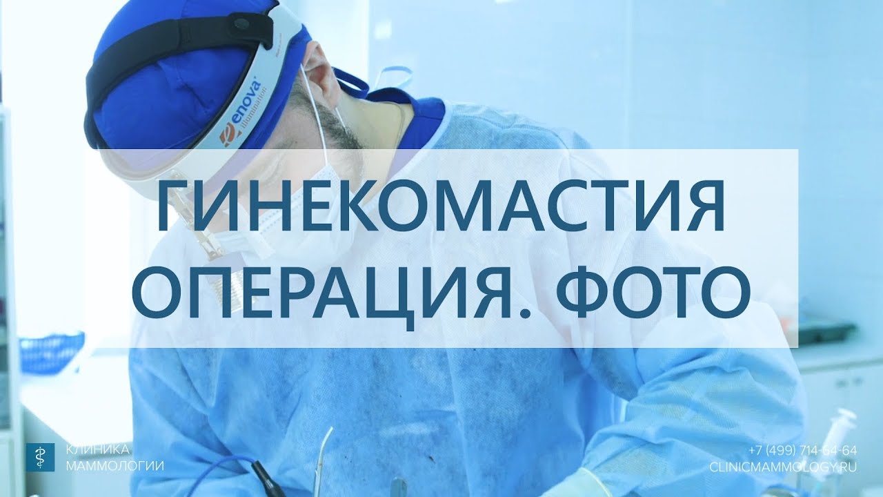 Гинекомастия Лечение гинекомастии операция и результат Youtube