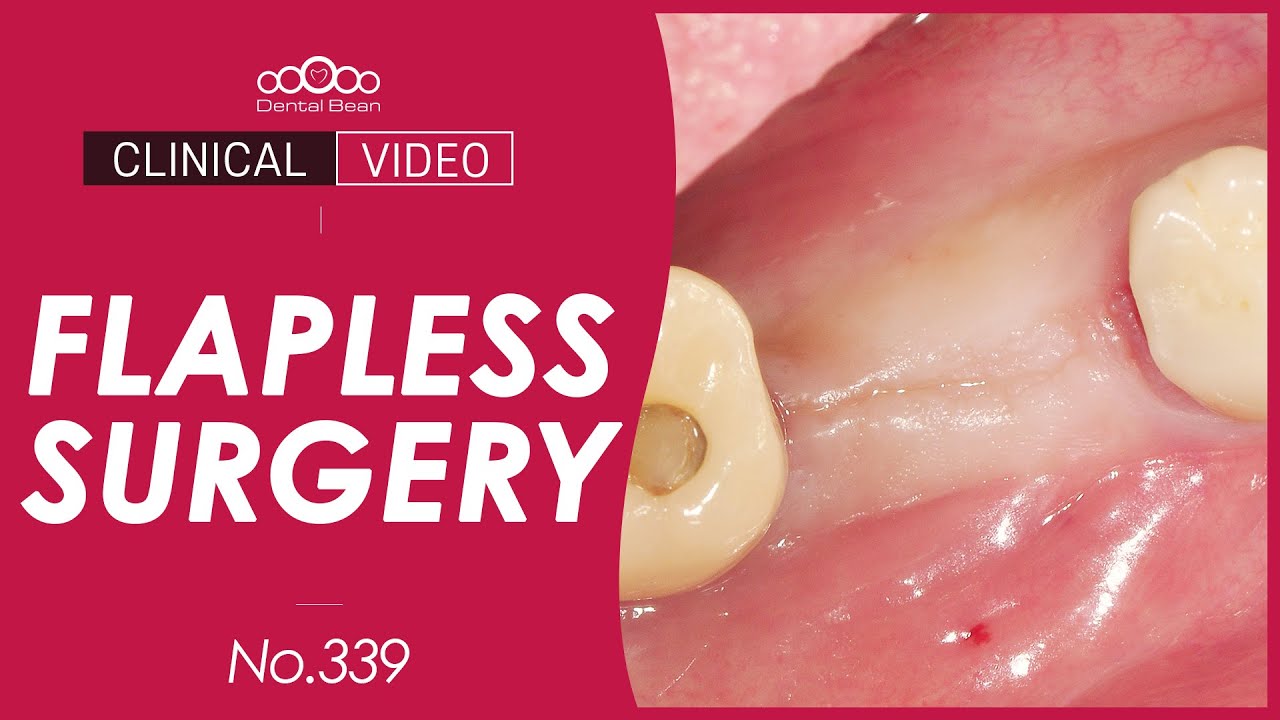 Flapless surgery on mandible posterior area [Dr. Kim Jaeyoon] - YouTube