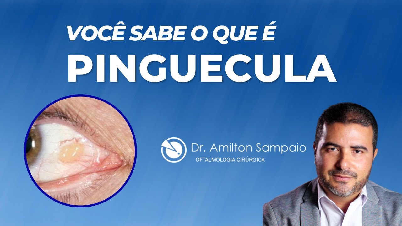 Pinguecula: o que é e como tratar? Saiba com o Dr. Amilton Sampaio ...