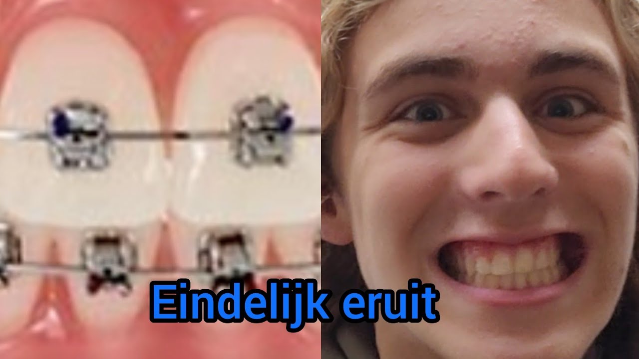 eindelijk is mijn Beugel eruit!!!. ik heb eindelijk geen last meer van ...