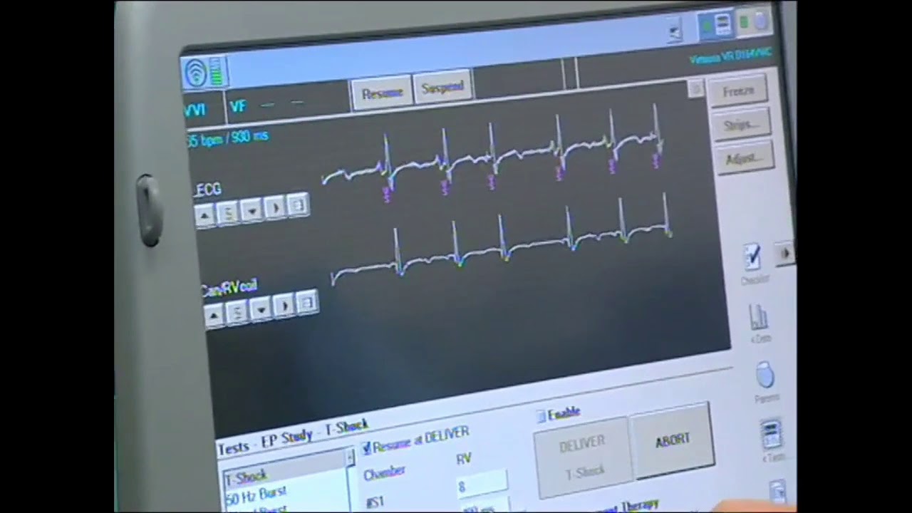 Testing the ICD once implanted - YouTube