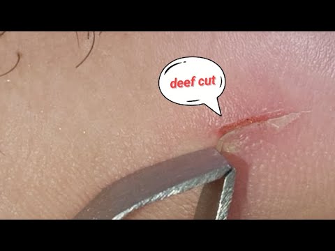 Deef cut in foot 🦶 - YouTube