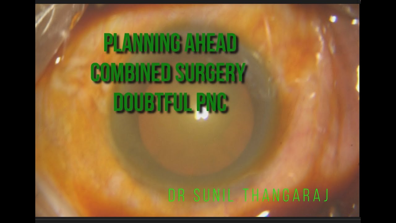 Diabetic soft cataract use of mechanical chops with long chopper and ...