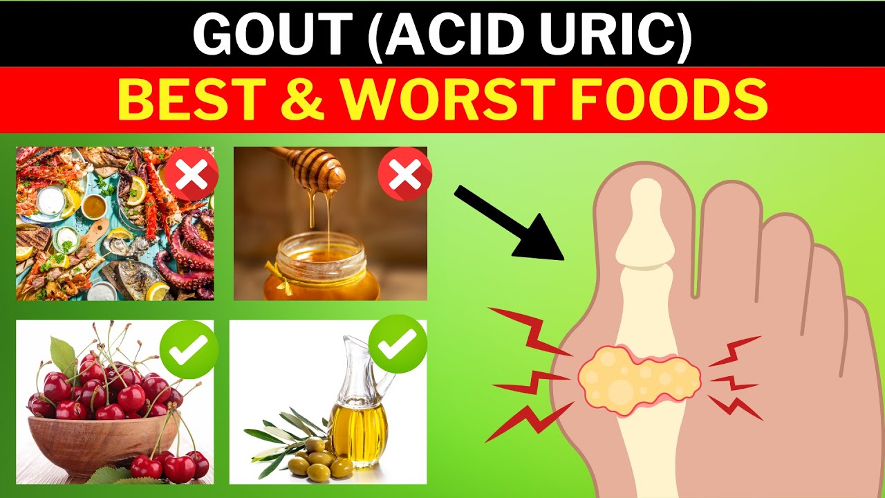 5 Worst & 5 Best Foods to Eat with Gout Reduce Risk of Gout Attacks and ...