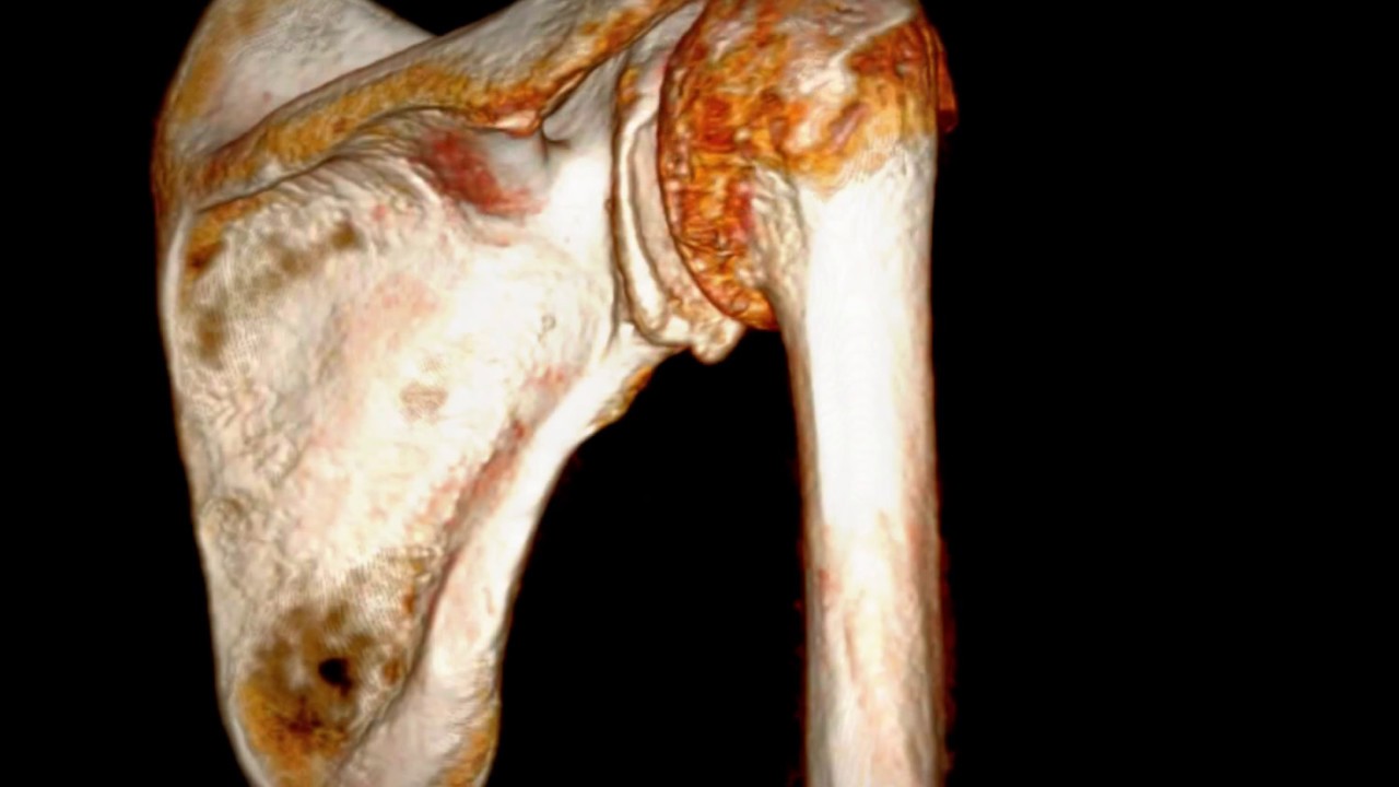 Shoulder Arhritis : Degenerative osteoarthritis - YouTube