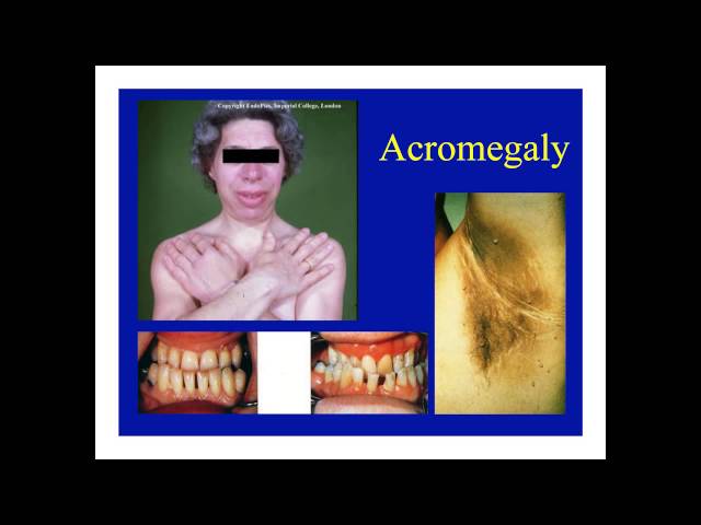 Acromegaly Teeth