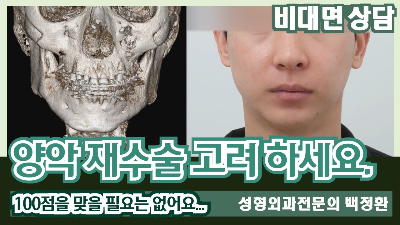 (SUB) 양악 재수술 고려하세요 [비대면상담 269] / Consider double-maxillary revision ...