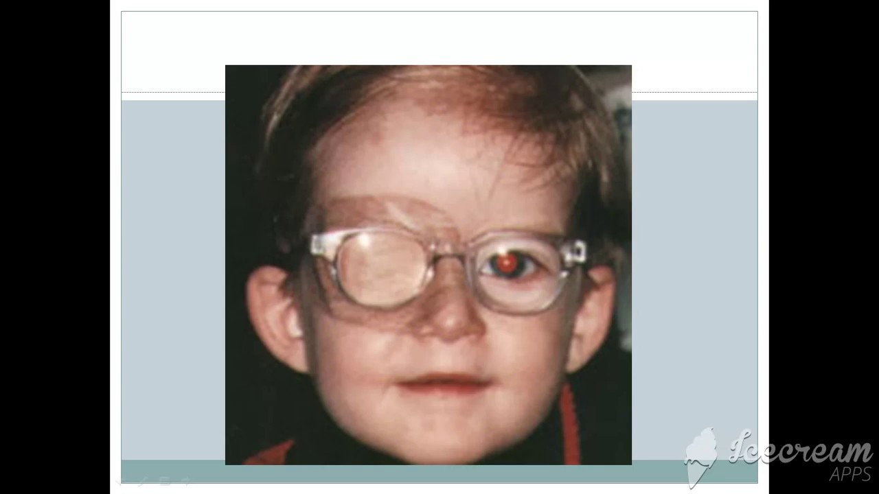 AMBLYOPIA | LAZY EYE | Optometry clinic | eye disease | eye disease in ...