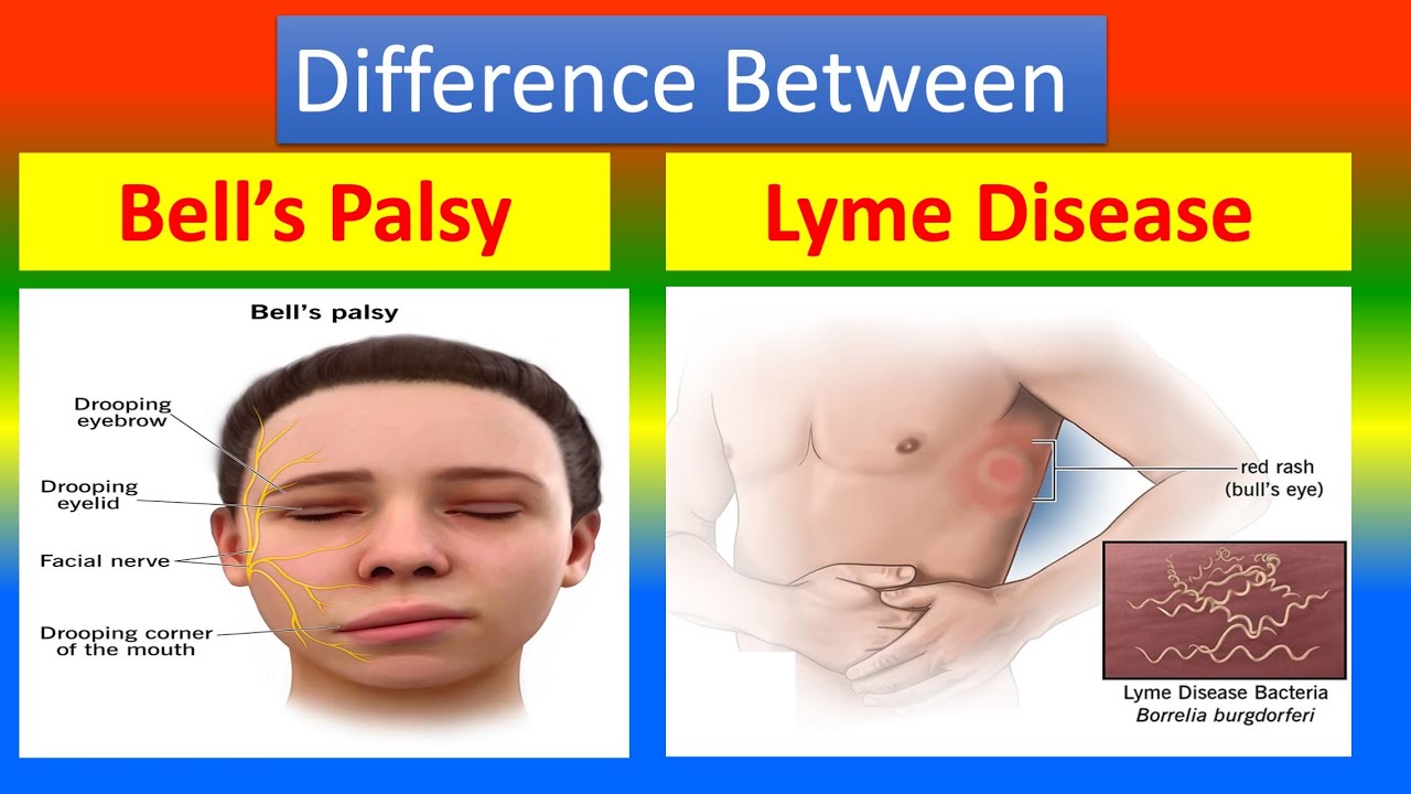 Difference Between Bell’s Palsy and Lyme Disease - YouTube