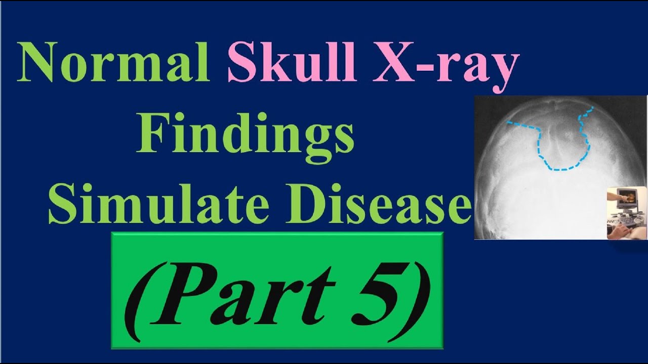 Normal Skull X-ray Findings Simulate Disease (part 5)-Calvarial ...