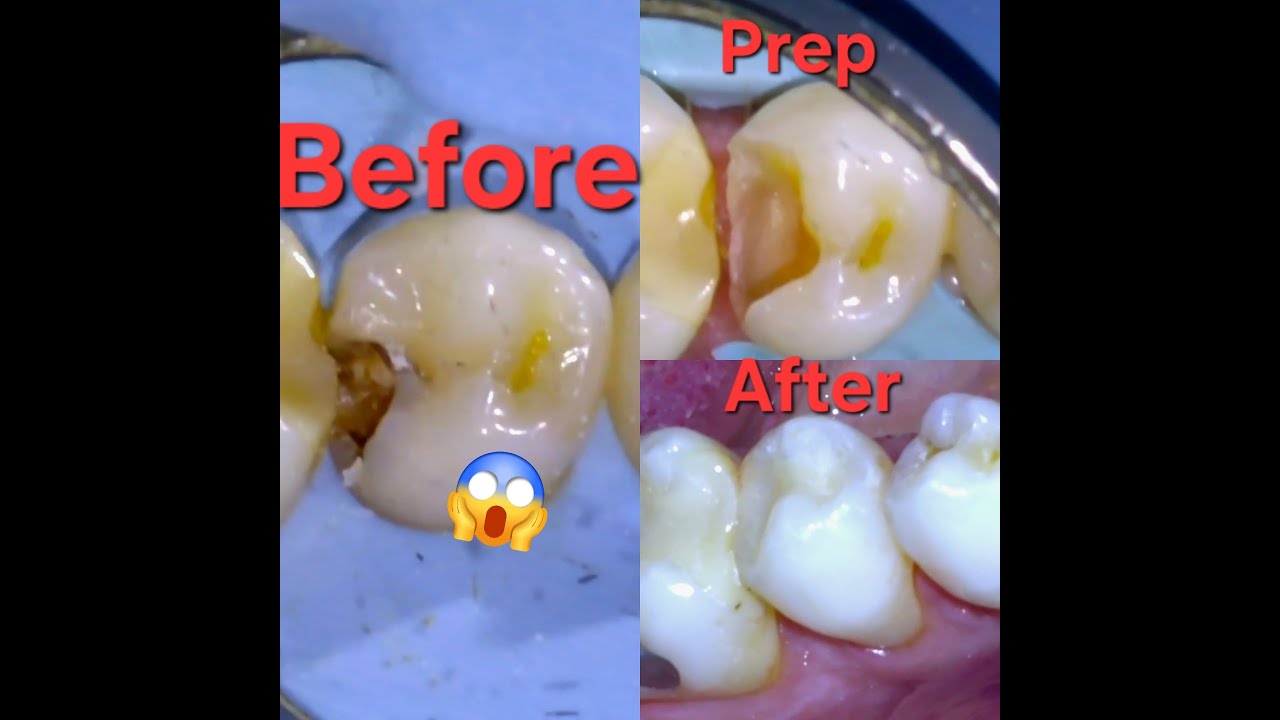 [38] Monster cavity saved with a dental filling - YouTube