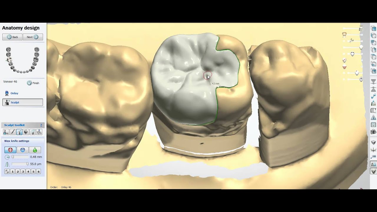 Onlay (Inlays and Veneers) - YouTube