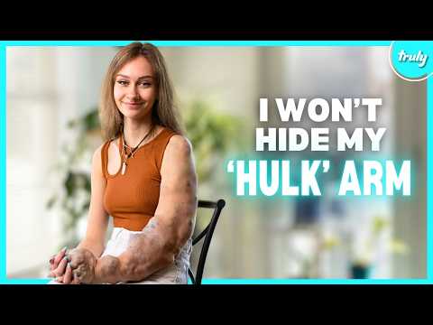 Bullies Called Me ‘The Hulk’ - But I Love My Swollen Arm | BORN DIFFERENT