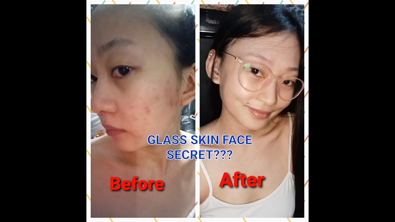 Tips in How to have Glass Skin Face/ Pimple/ Ache Solution Treatment ...