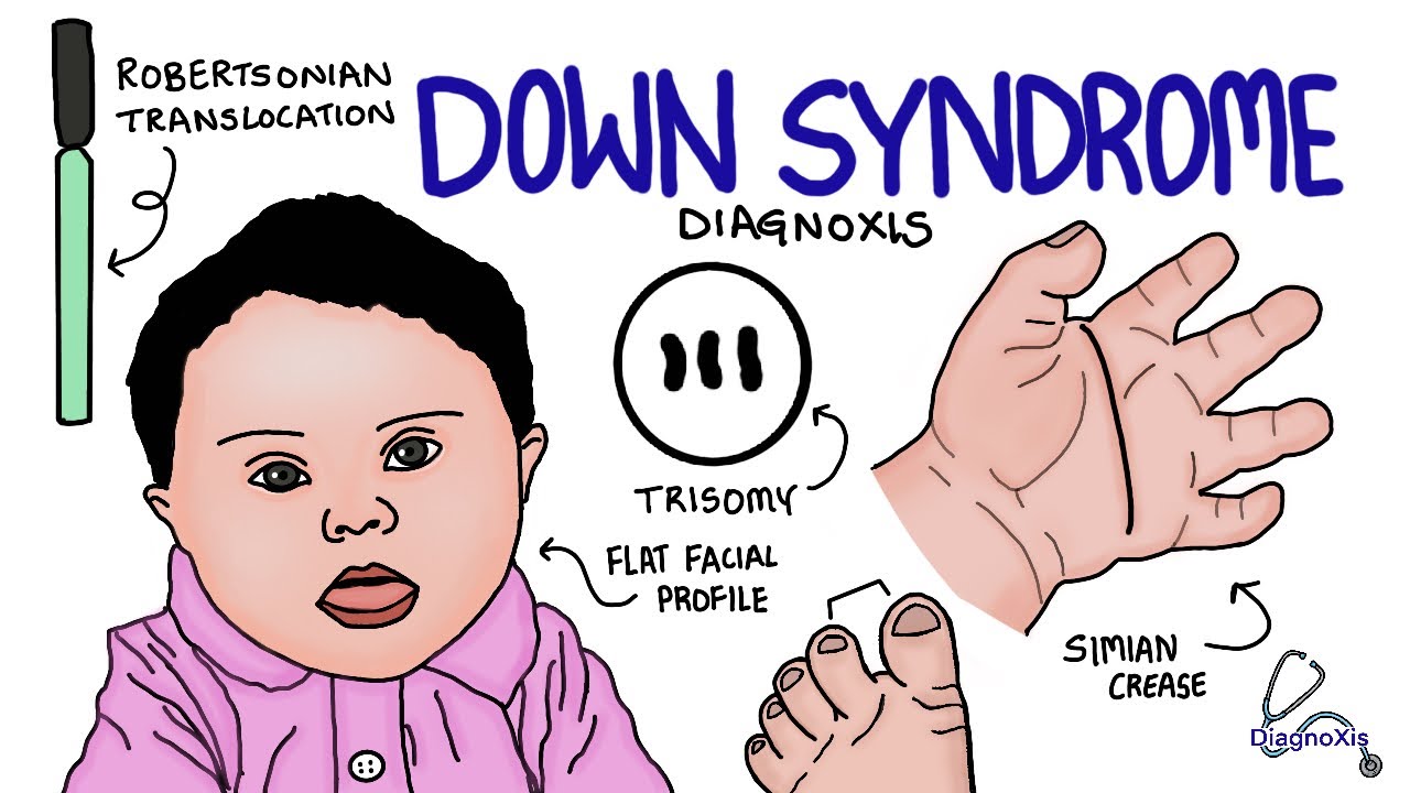 Down syndrome explained - YouTube