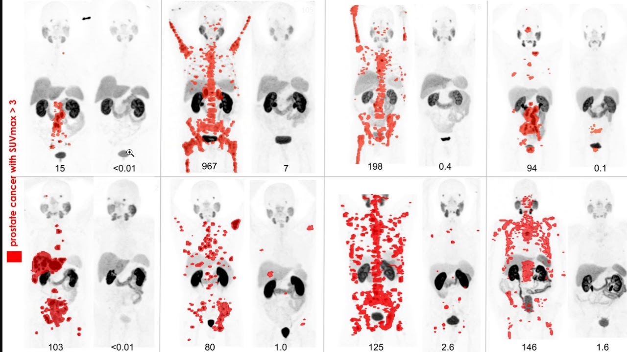 액상생검을 통해 살펴본 전립선암의 실체 - YouTube