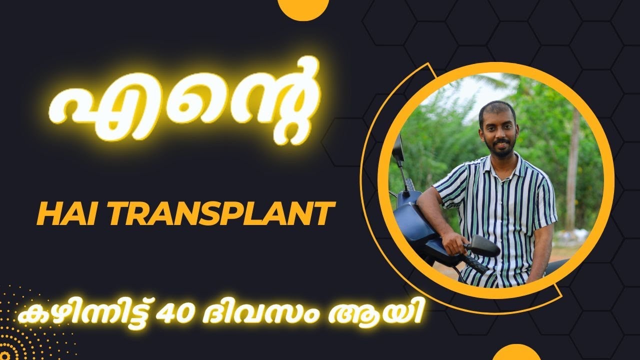Hair transplantation after 40 days | കാര്യമായ മാറ്റങ്ങൾ ഒന്നും ഇല്ലാതെ | safvan pullara - YouTube
