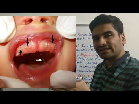 GINGIVAL CYSTS OF NEW BORN / EPSTEIN PEARLS / BOHNS NODULES / DENTAL ...
