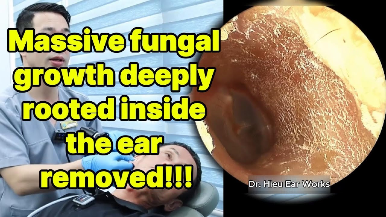 Massive fungal growth deeply rooted inside the ear | ear cleaning ...