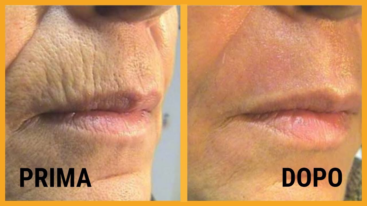 Come RIMUOVERE LE RUGHE INTORNO ALLA BOCCA in modo naturale e nel più ...