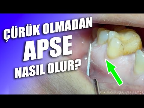 Çürük Olmayan Diş Apse Yapar mı?