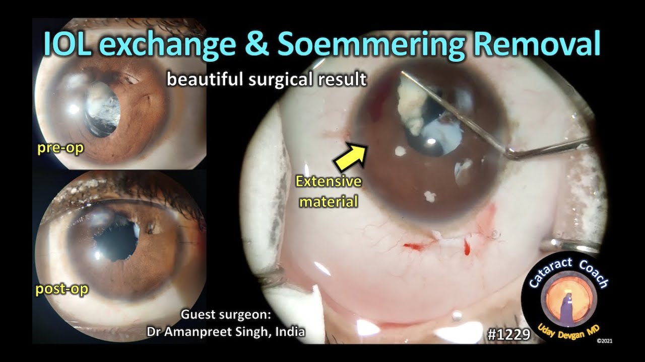CataractCoach 1229: IOL exchange and Soemmering & cortex removal - YouTube