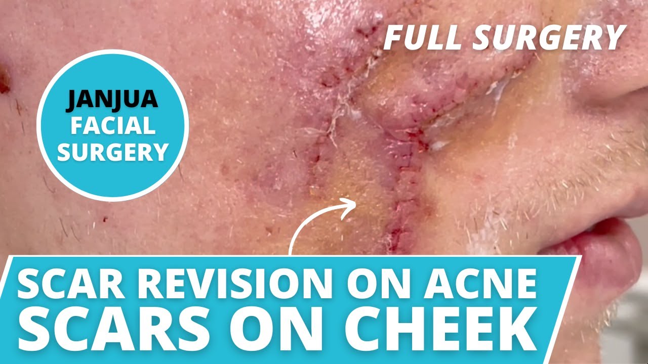 SCAR REVISION ON ACNE SCARS ON CHEEK (LIVE SURGERY) - DR. TANVEER ...
