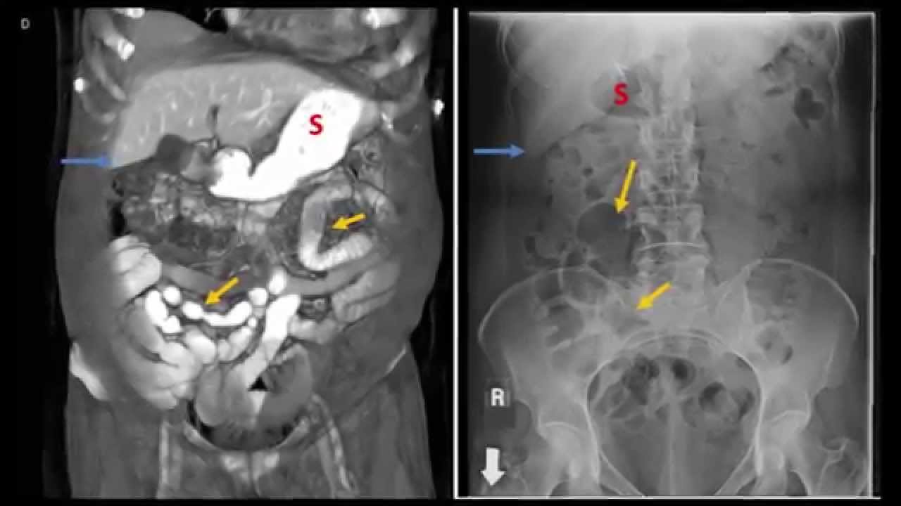 Faster Healing for Abdominal Surgery - YouTube