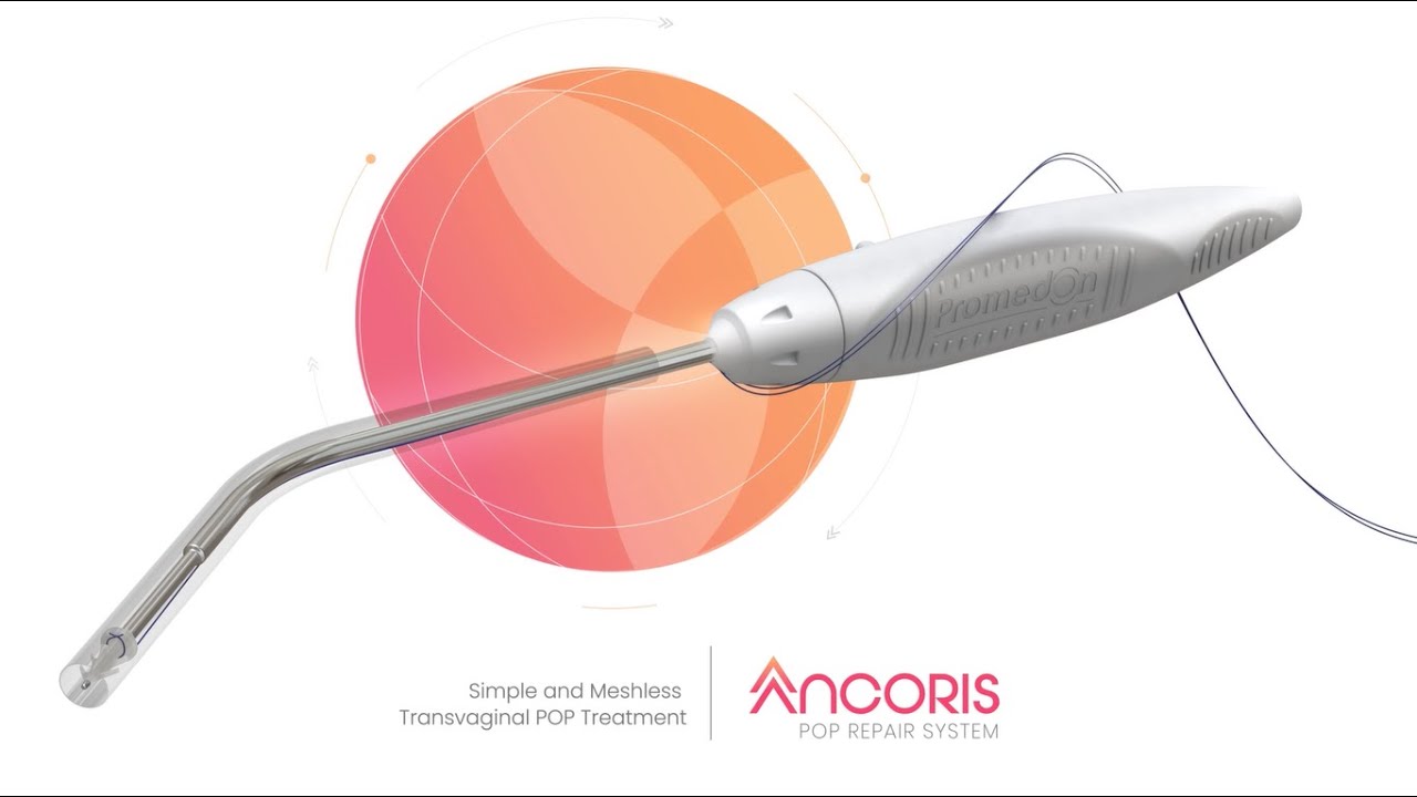 Ancoris POP Repair System Product Presentation - YouTube