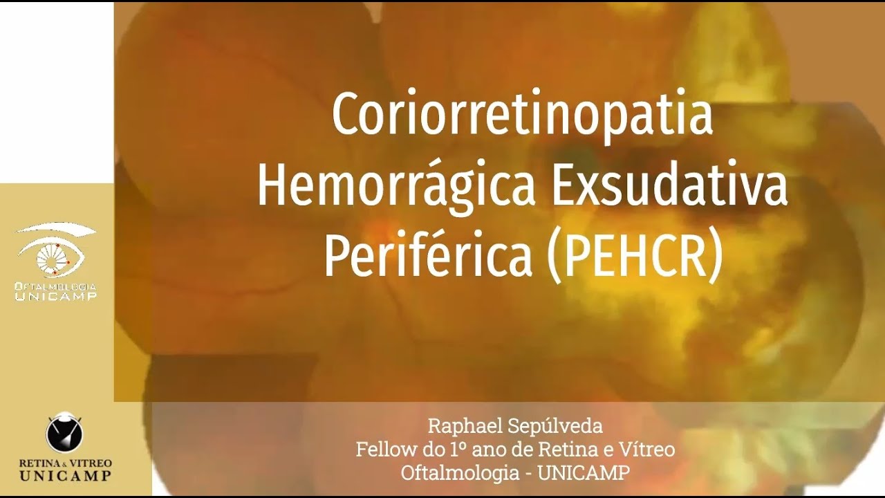 Retina e Vítreo (10-08-2023) - Coriorretinopatia Hemorrágica Exsudativa ...