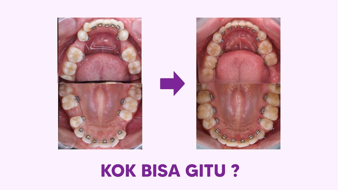 Timelapse - Pergerakan Gigi Pada Pasien Behel Lingual - YouTube