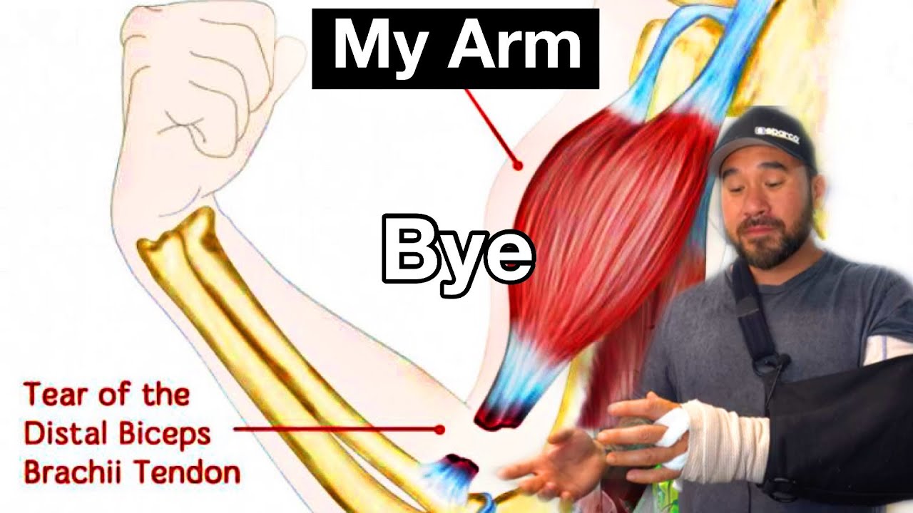Distal Bicep Tear While Installing A Honda Transmission Youtube