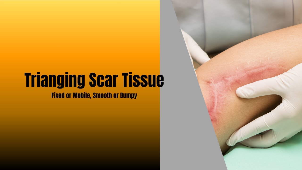 What To Look For When Scar Tissues Need To Be Tattooed - YouTube
