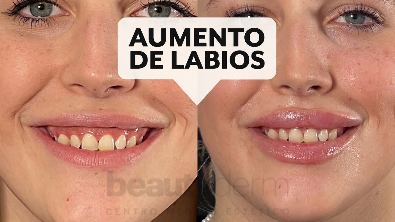 Aumento de Labios + Correccion - Utilizamos hialuronidasa para corregir ...