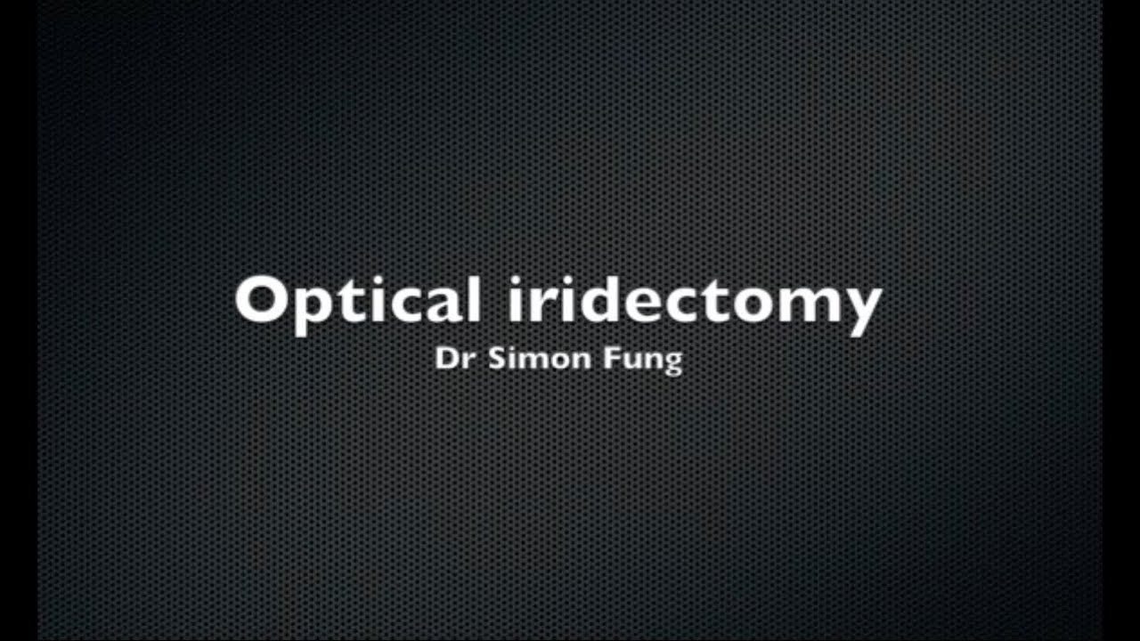 Optical iridectomy - YouTube