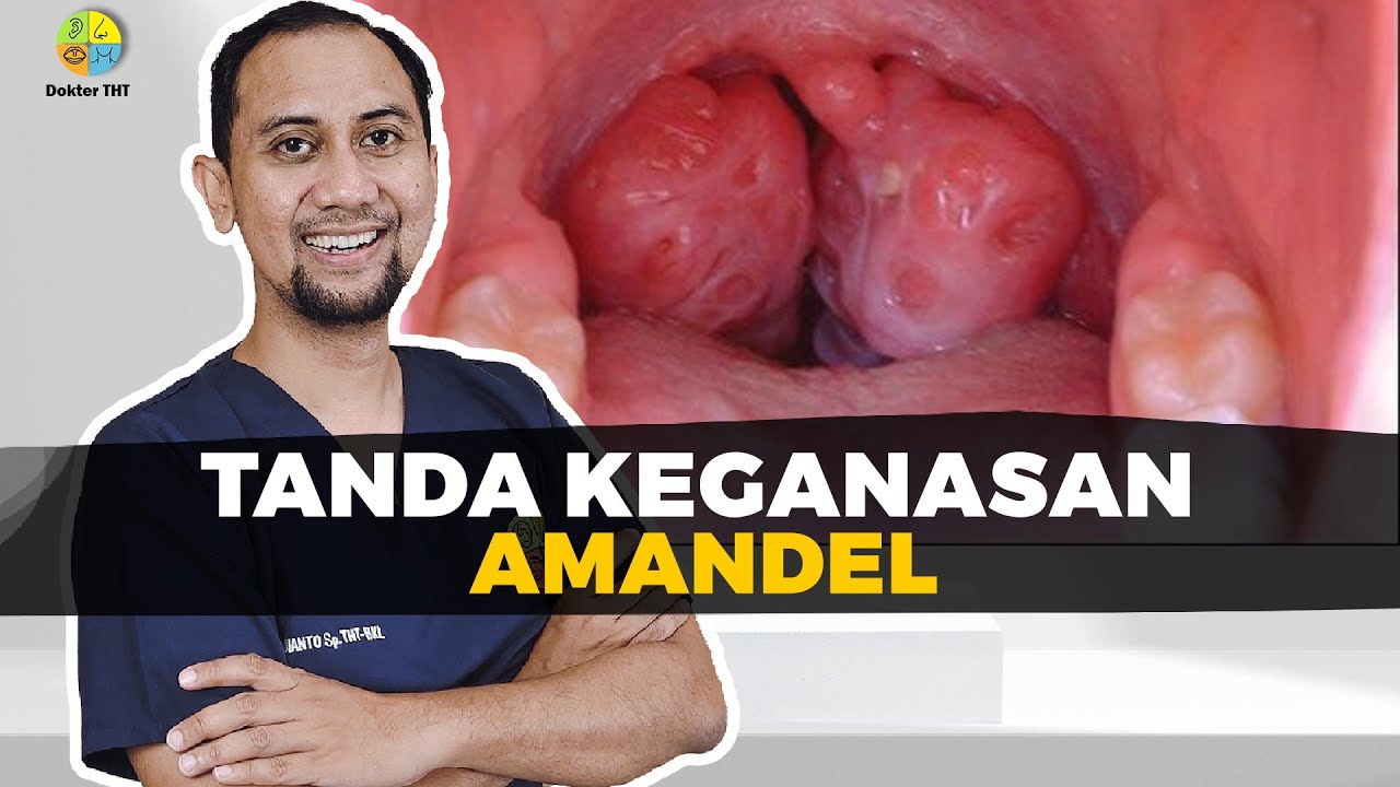 TANDA KEGANASAN AMANDEL - YouTube