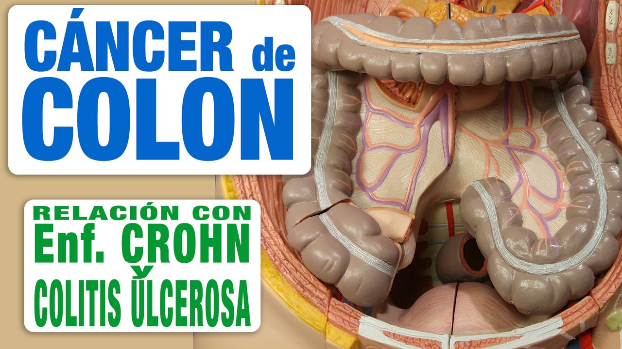 Cáncer de Colon y Enfermedad Inflamatoria Intestinal - YouTube