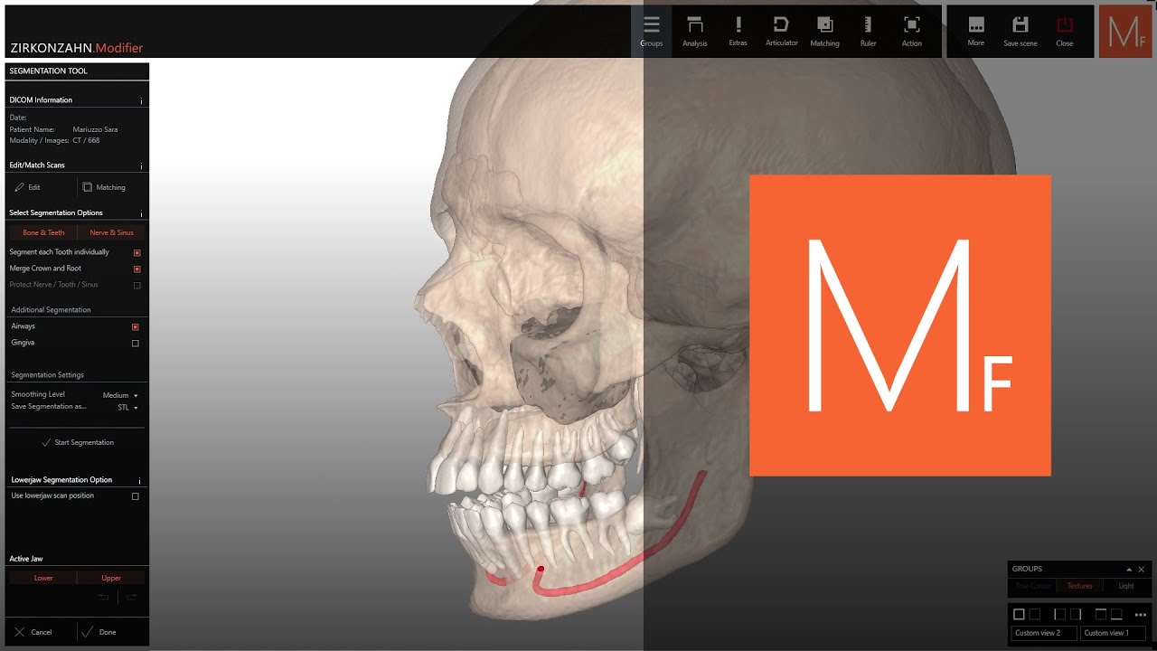 Bone Doctor software module | Zirkonzahn.Modifier - YouTube