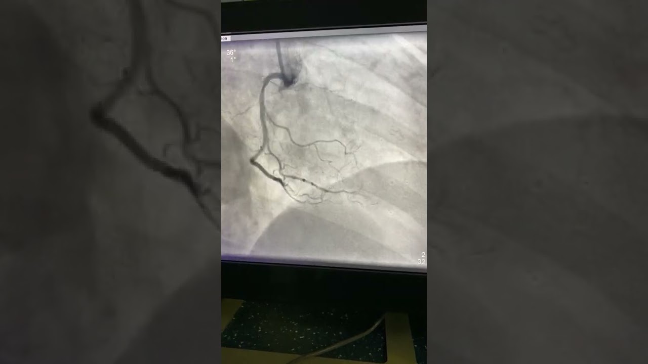 3VD | Three Vessel’s Disease | Diagnostic Coronary Angiogram | Cardiac ...