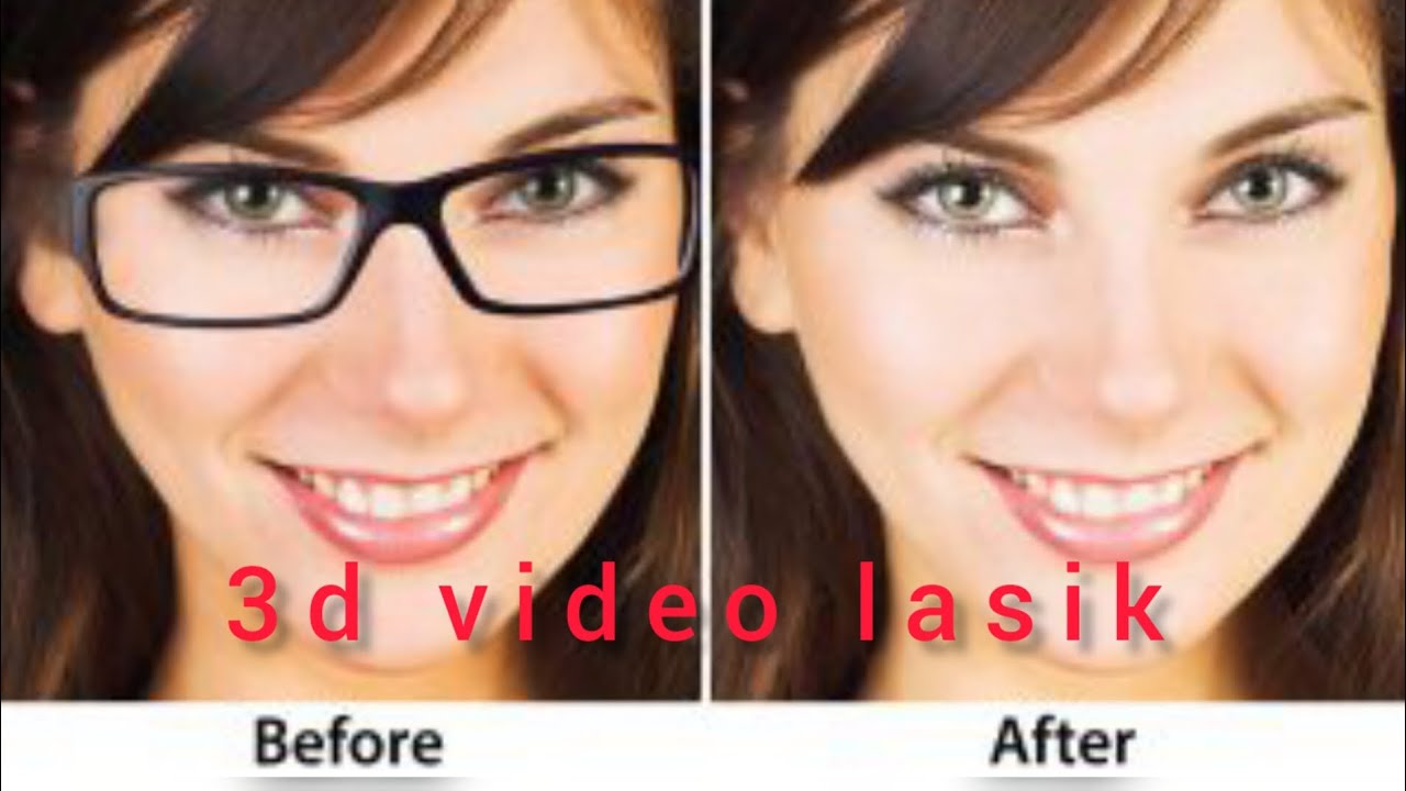 Lasik eye surgery full animation video - YouTube