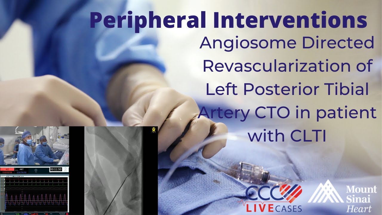 Angiosome Directed Revascularization of Left Posterior Tibial Artery ...