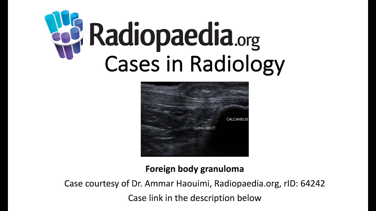 Foreign body granuloma (Radiopaedia.org) Cases in Radiology - YouTube