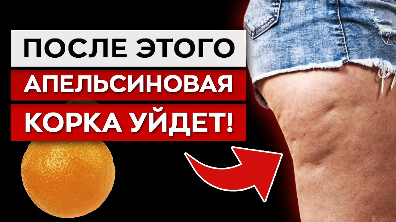Целлюлит УБЬЁТ красоту вашей кожи Как избавиться от целлюлита Youtube