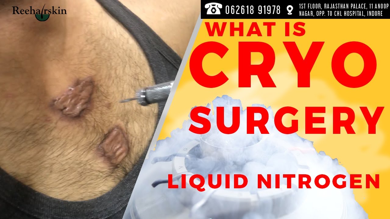 Learn about cryo surgery with liquid nitrogen - YouTube