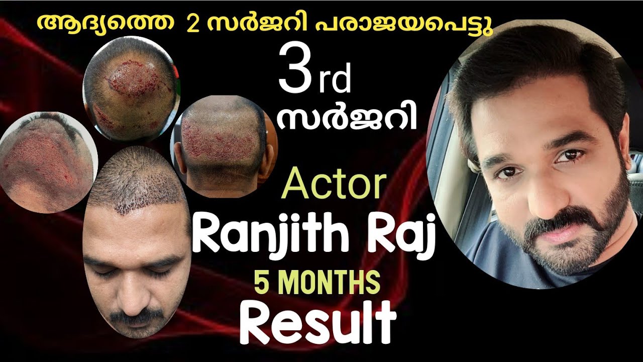 ഇത് ഒരു അത്ഭുതം തന്നെ, 3 പ്രാവിശ്യം Hair Transplant സർജറി, Actor Ranjith Raj പ്രതികരിക്കുന്നു 💪👌 ...
