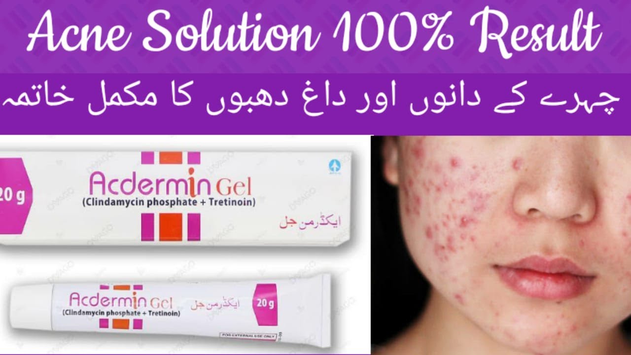 Acdermin gel for acne reviews- my acne journey-Acdermin gel-acne cream ...