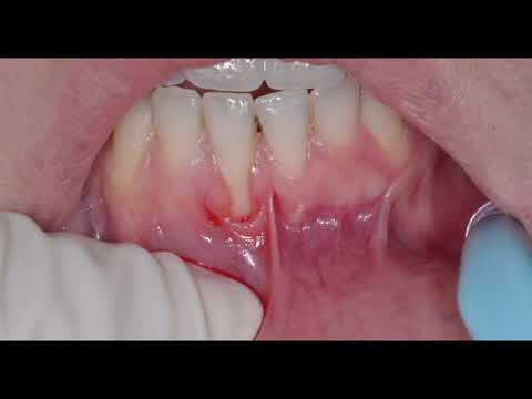 Mandibular recession coverage with subepithilial ctg from palate by dr ...